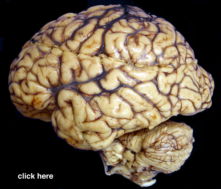 Brain Image | Renaissance School of Medicine at Stony Brook University